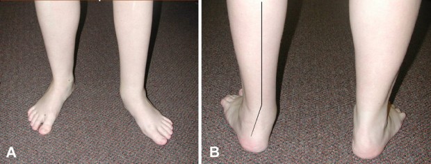 Pes Planus - Yaletown Chiropractic, RMT & Orthotics Clinic of Downtown ...